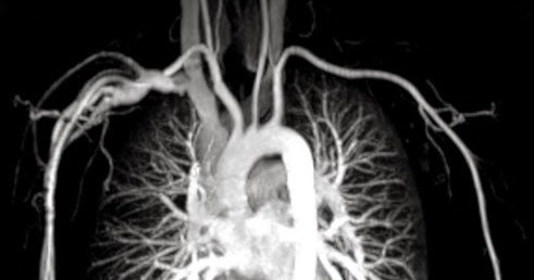 MRI Protocols: Thoracic aorta MRI techniques