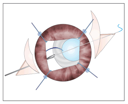 Journal and Conferences on Ophthalmology: Scleral Fixation of Sinking ...