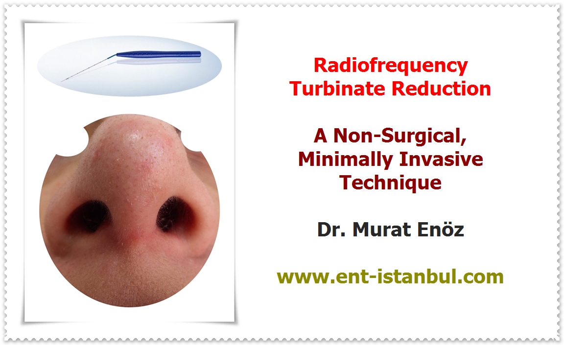 Turbinate Hypertrophy - Definition, Symptoms, Causes and Treatment
