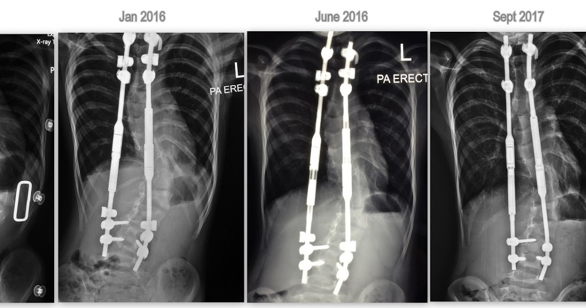 Life with Beals: Second surgery - new rods