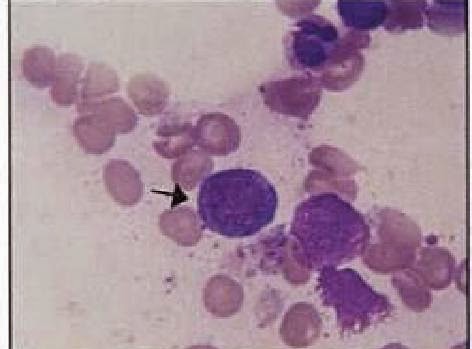 fichero hematologia: Eritroblasto policromatico