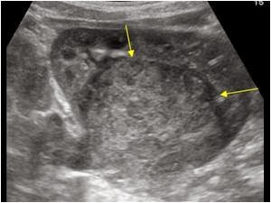 Wilm's Tumor: a pediatric cancer : January 2015