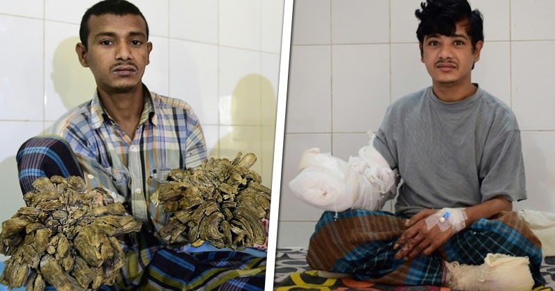 Tree Man Of Bangladesh Cured Of Condition That Turned His Hands Into ...