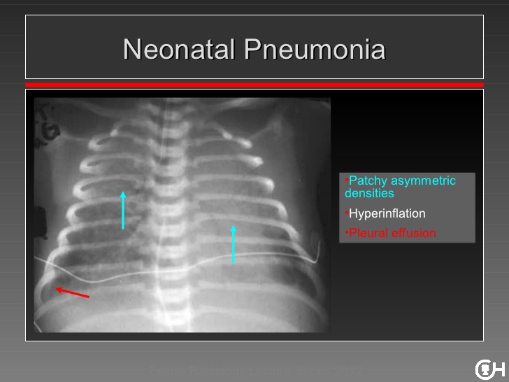 What caused Pneumonia-Neonatal? - Baby Care Tips