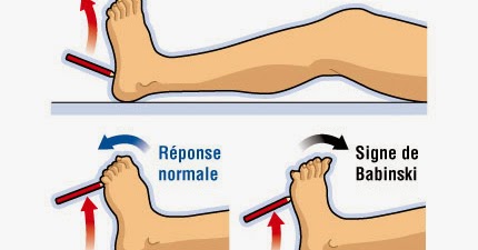 Sémiologie en neurologie | Récap' IDE