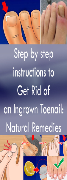 Step by step instructions to Get Rid of an Ingrown Toenail: Natural ...