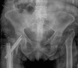 Ressecção da extremidade superior do fémur esq – Girdlestone ...