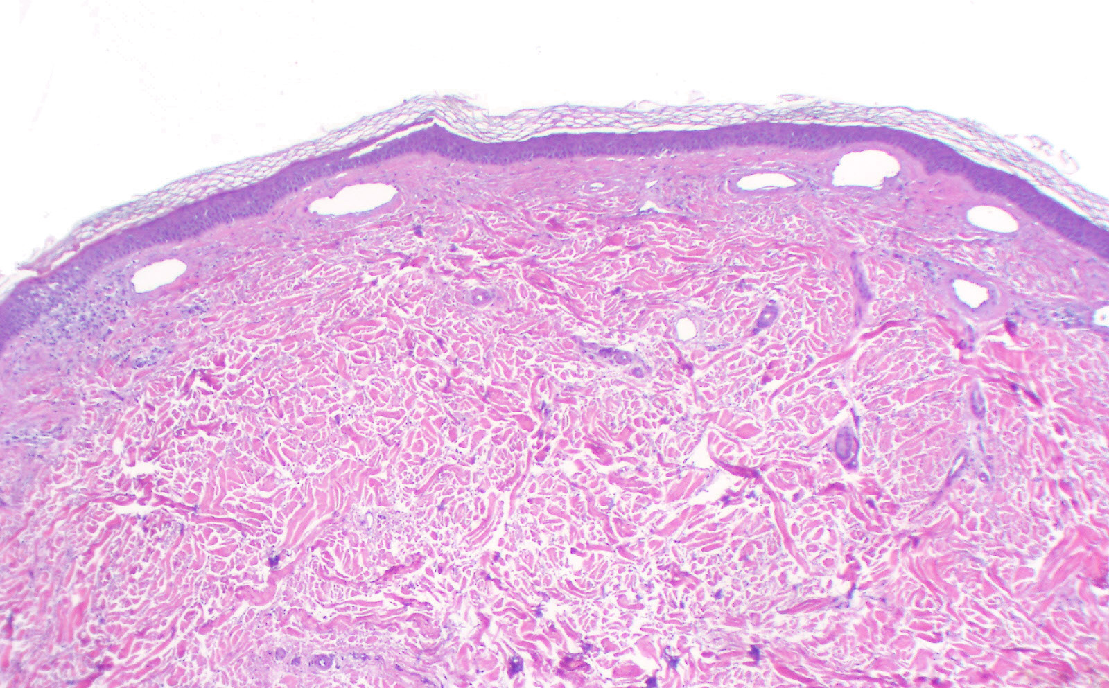 VIRTUAL GRAND ROUNDS IN DERMATOLOGY 2.0: Unusual Vascular Pattern