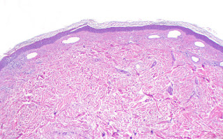 VIRTUAL GRAND ROUNDS IN DERMATOLOGY 2.0: Unusual Vascular Pattern
