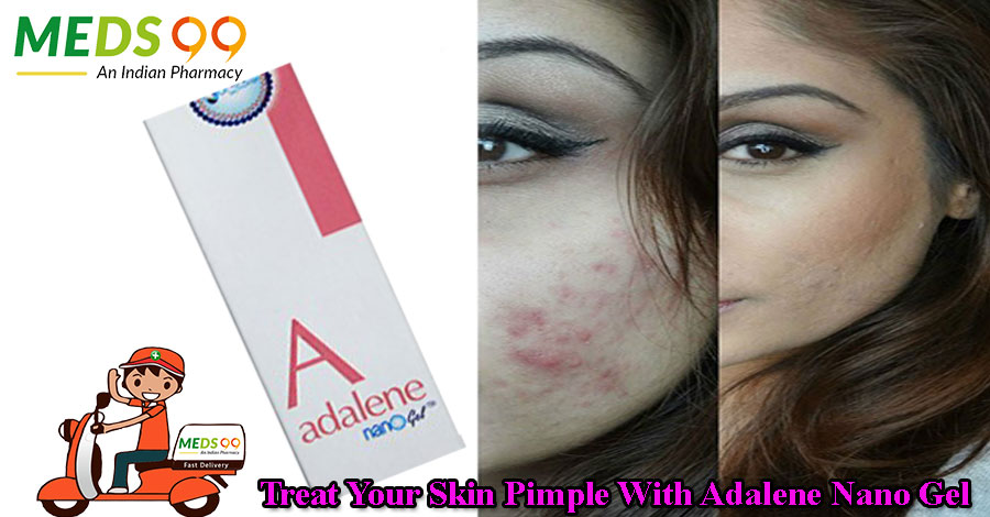 Get Complete Treatment of All the Acne Issues with Adalene Nano Gel
