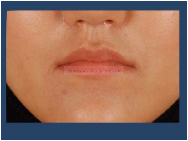 "Smile Lipt" Pembedahan Bibir Yang Popular di Korea ~ zamrispoon