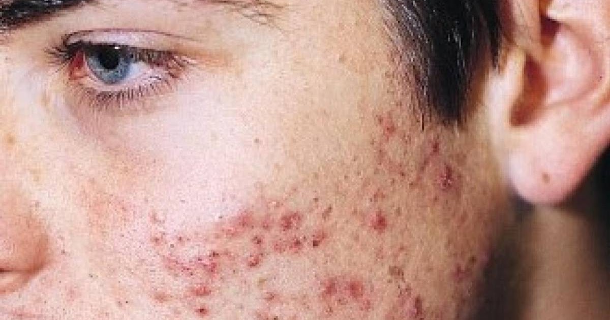 ELIMINAR LOS BARROS DE TU CARA CON MANGO ~ + Desde Mis Ojos