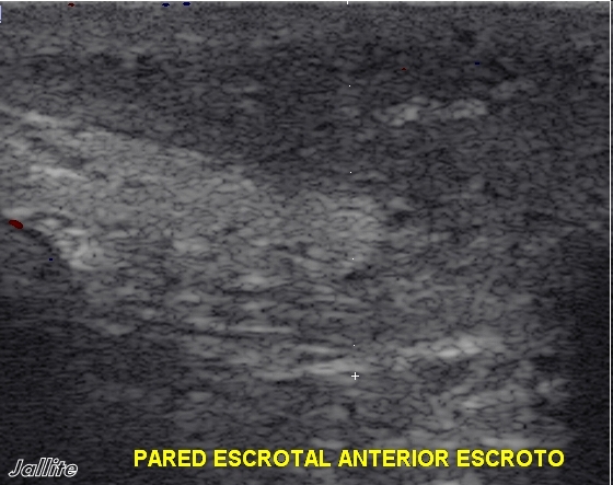 Engrosamiento Escrotal post Absceso