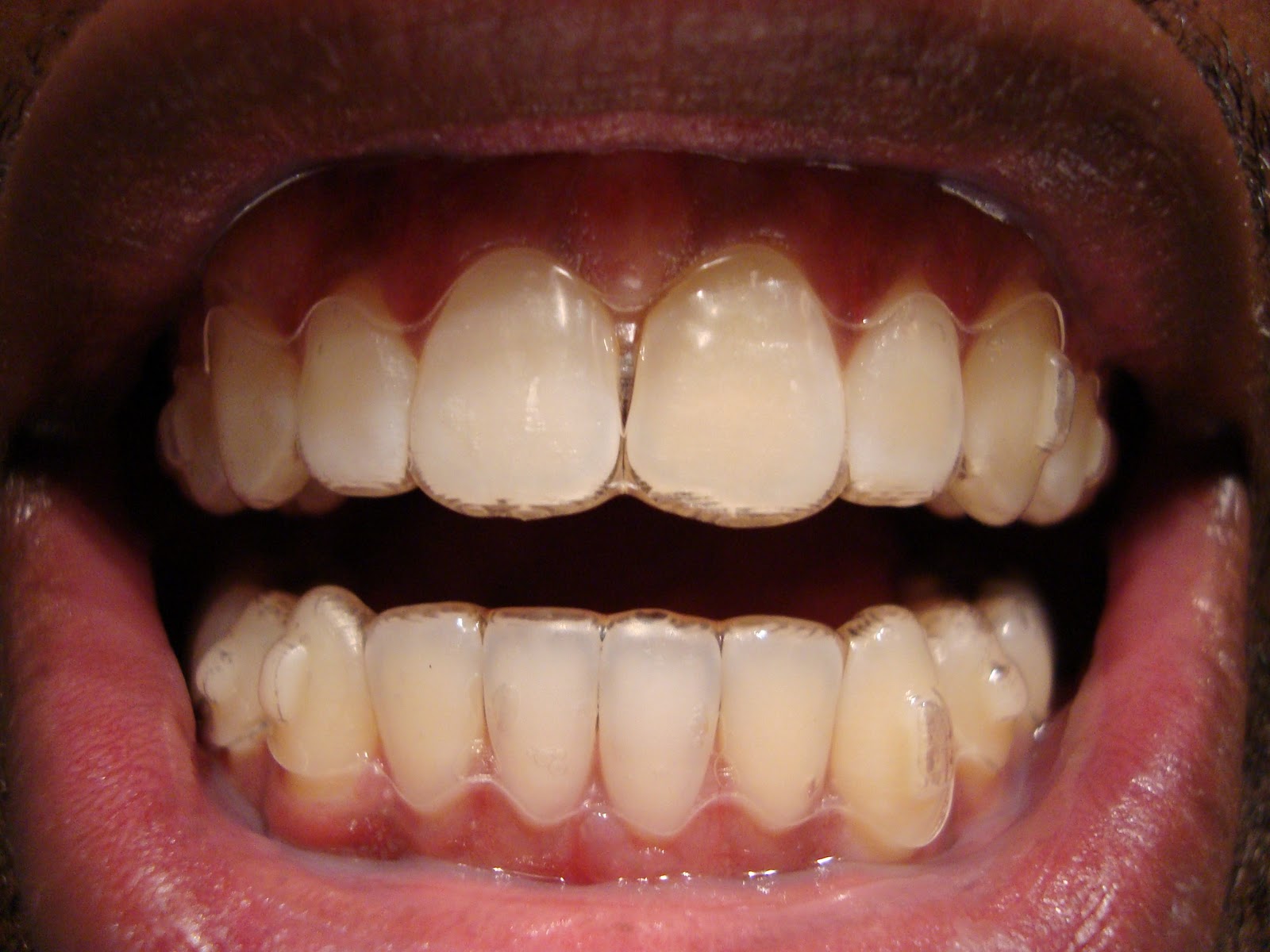 TRAY 27 Lower teeth done