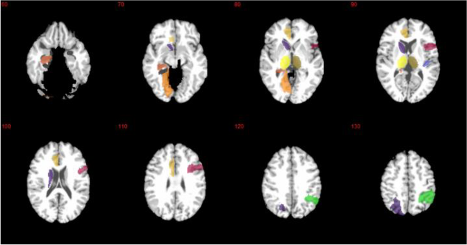 IQ prediction from structural MRI