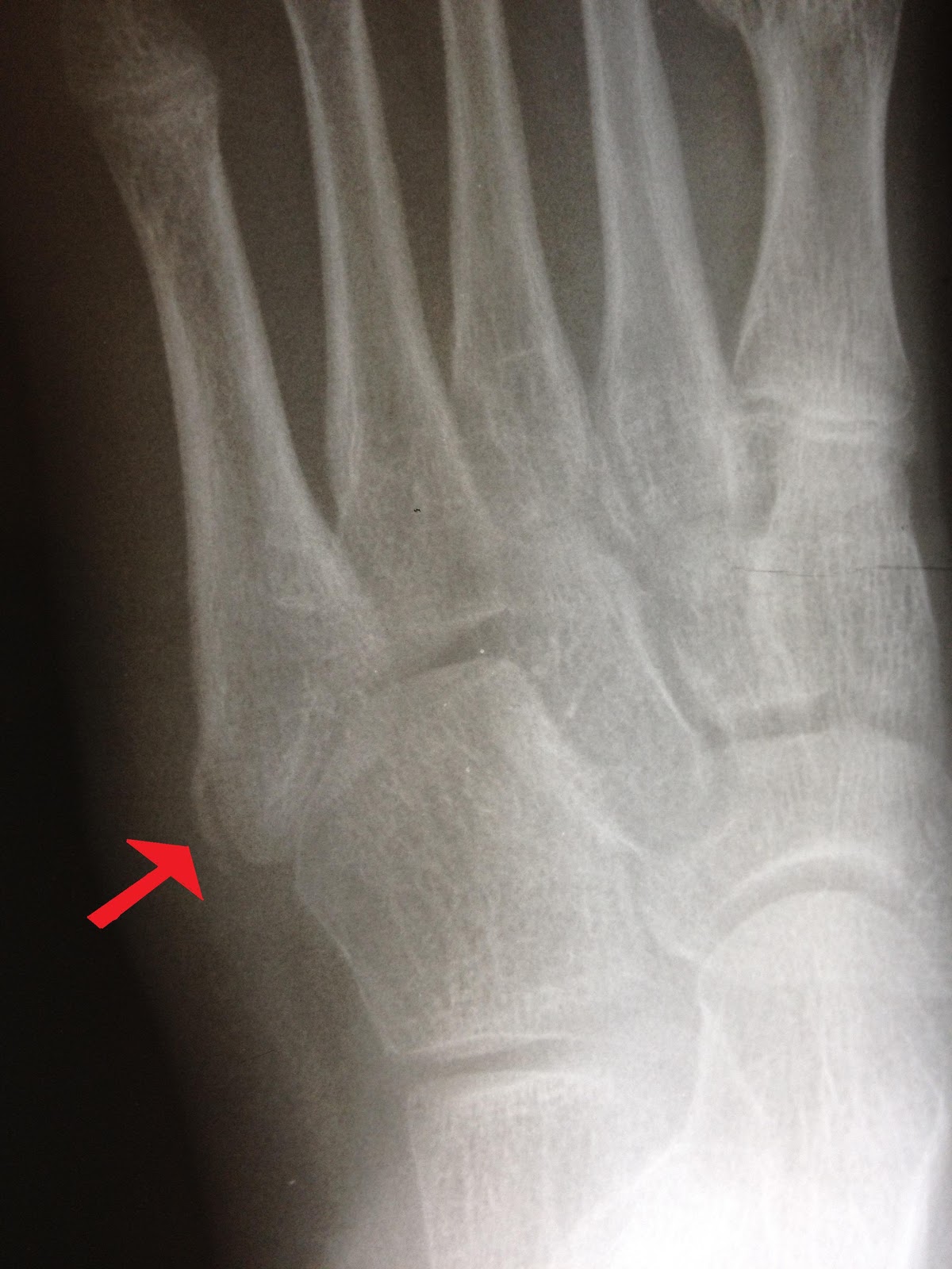 the short coat: A Pain in the the Foot