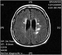 [B6] 多発性硬化症/視神経脊髄炎 (MS/NMO)
