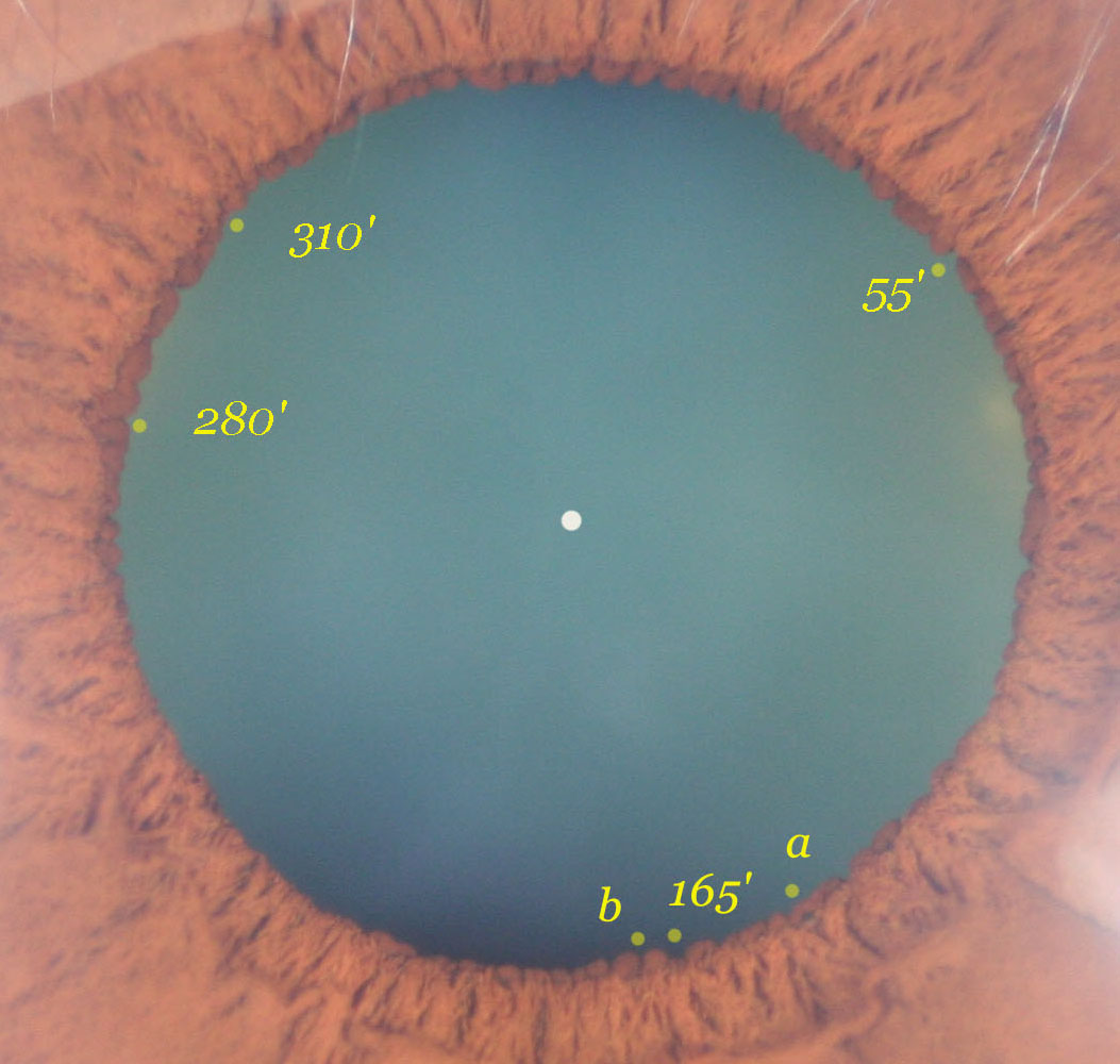 Modern & Multidimensional Iridology: Partial Atrophy/ Pearls ...