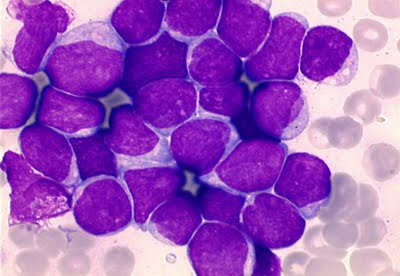 LEUCEMIES AIGUES LYMPHOBLASTIQUES (LAL) - BIOLOGIE MEDICALE