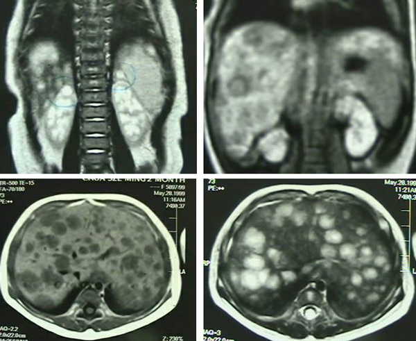 Ultrassonografia De Neuroblastoma