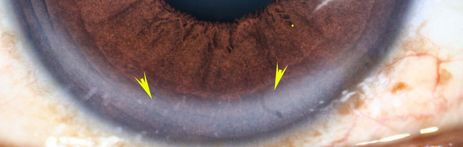 Modern & Multidimensional Iridology: IPB, Collarette Structure ...