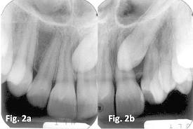 Dentistry and Medicine: ANOMALIES OF ERUPTION-THE ECTOPIC MAXILLARY CANINE