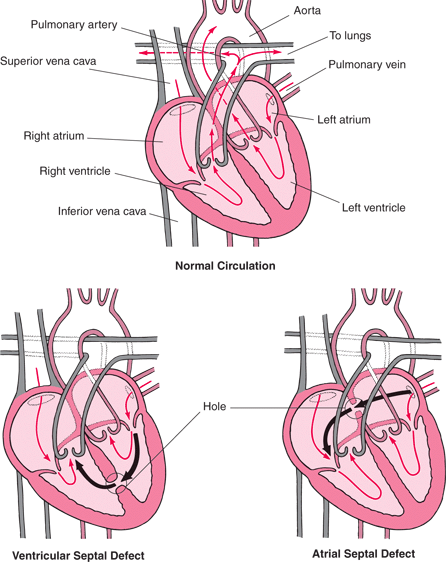 ASD (Atrial Septa Defect) ~ TheBloLabo.
