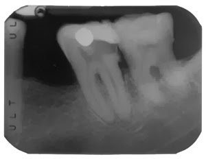 INTERPRETACION DE CARIES RADIOGRAFICAMENTE: La caries radiográficamente