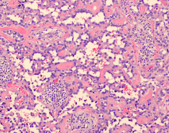 Angiosarcoma Histology