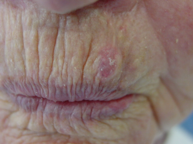 Dermatology For Dentists and Dental Students: Lips