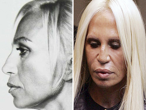 Donatella Versace Plastic Surgery