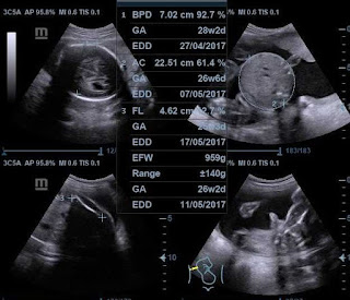 HAMIL: Cara Baca Hasil USG Kehamilan