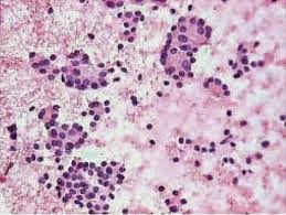 Anatomía patologica: Células tiroideas y coloide