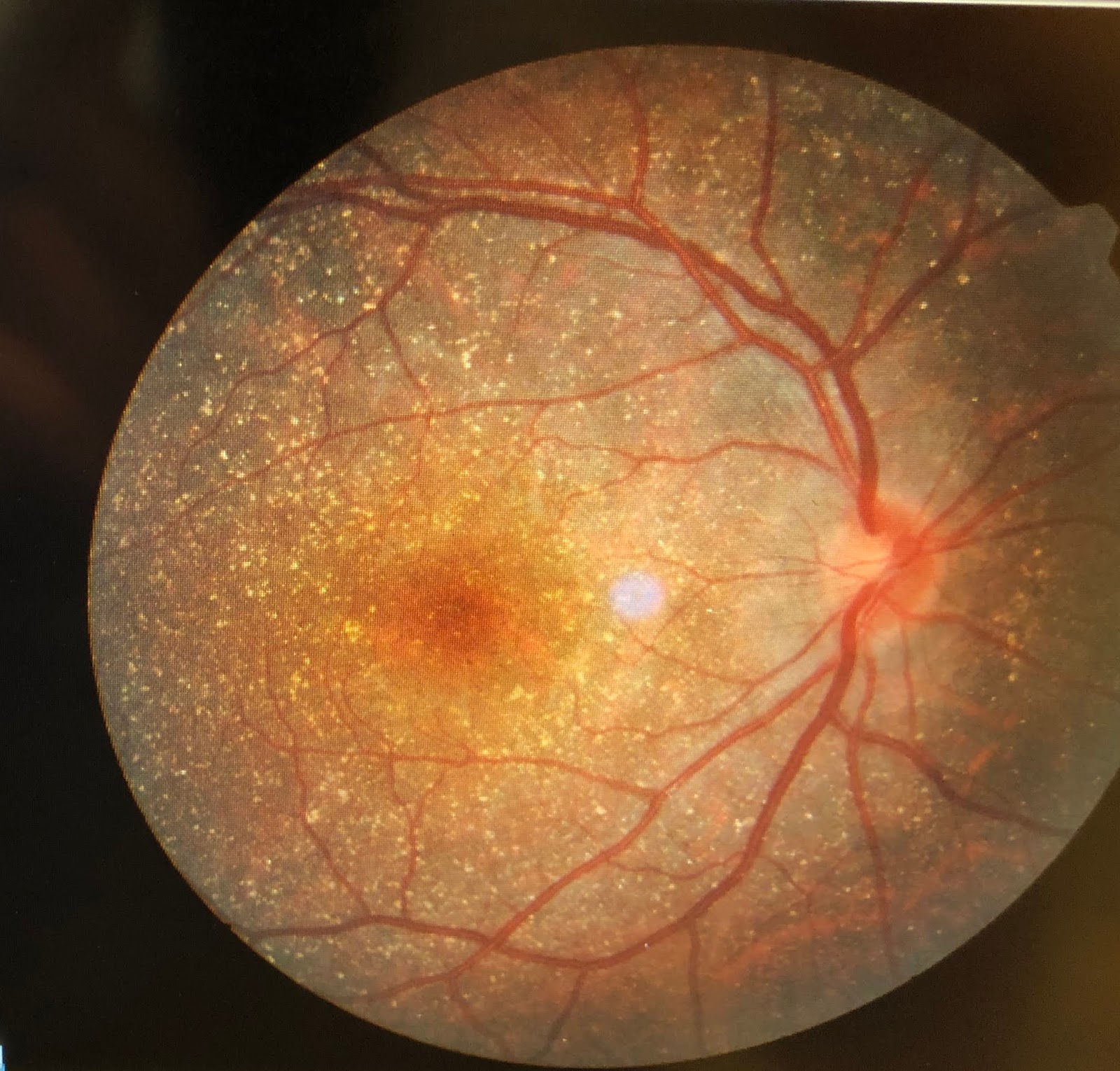 Beverly Hills Optometry (Dr Kambiz Silani): Bietti's Retinal ...