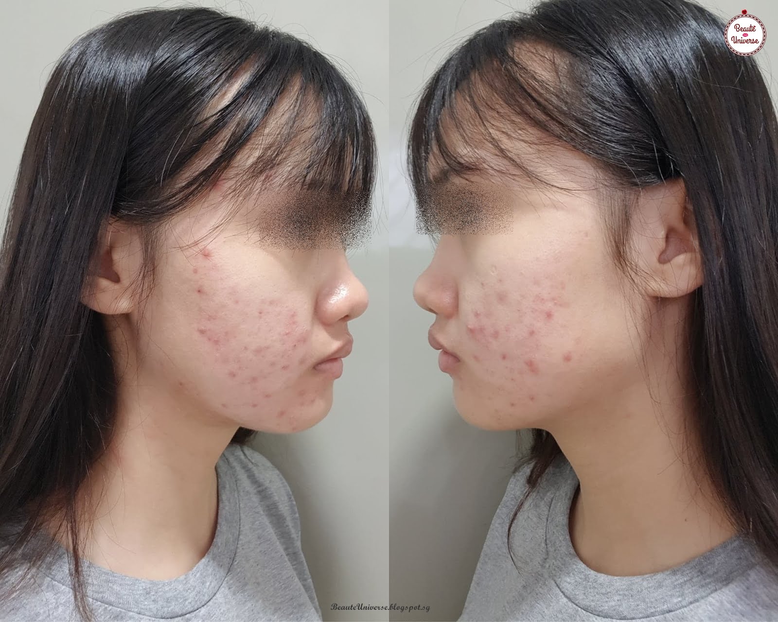 Beauté Universe: The Acne Struggles Journey -- Part 1 [Updated]