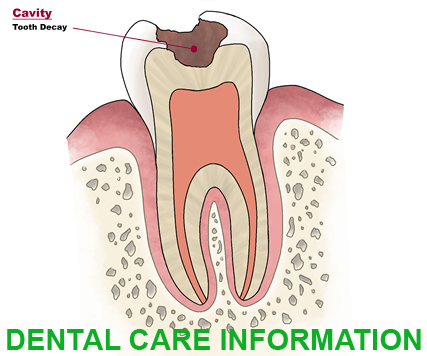 DENTAL CARE INFORMATION: All About Cavities