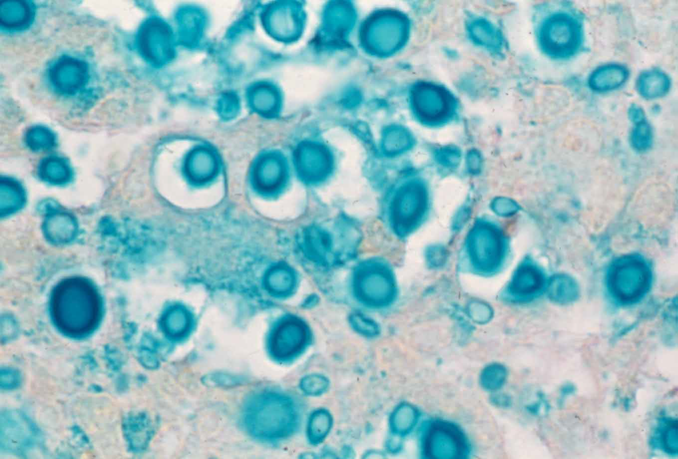 Histopatología: Criptococosis