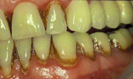 COMO LIMPIAR EL SARRO NATURALMENTE, CONSEJOS 100% EFECTIVO, ¡Adios mal ...