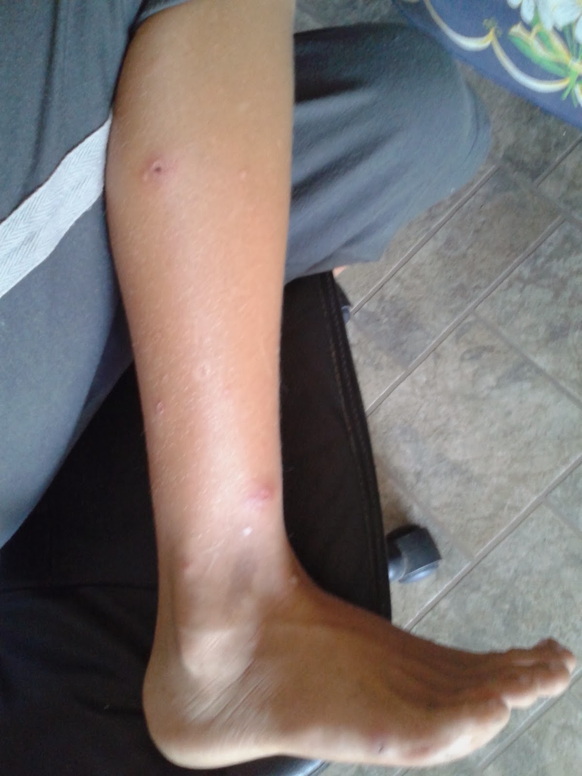 Ilan Life: 'Tis the season for staph and streptococcus