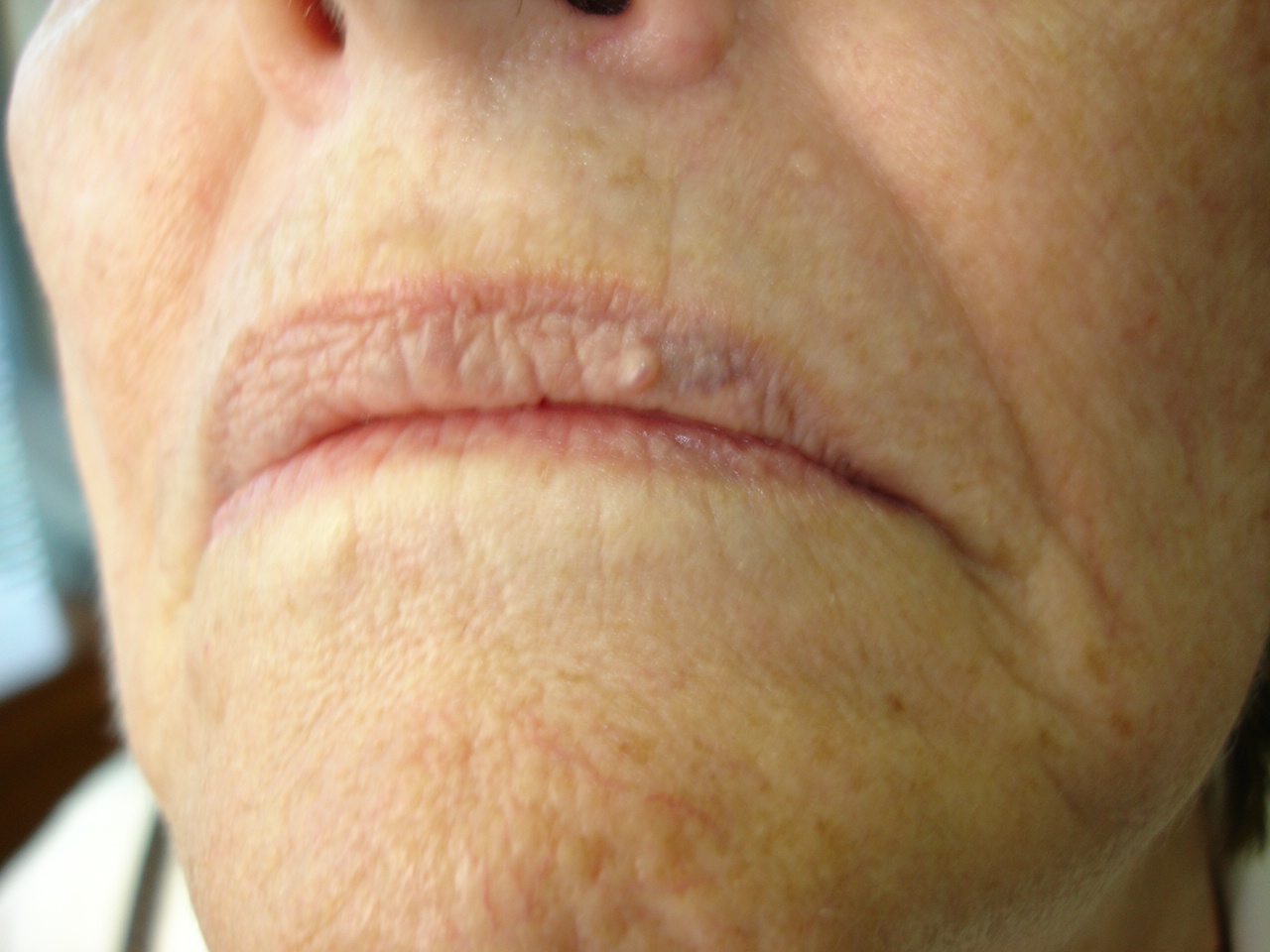 Dermatology For Dentists and Dental Students: Lips