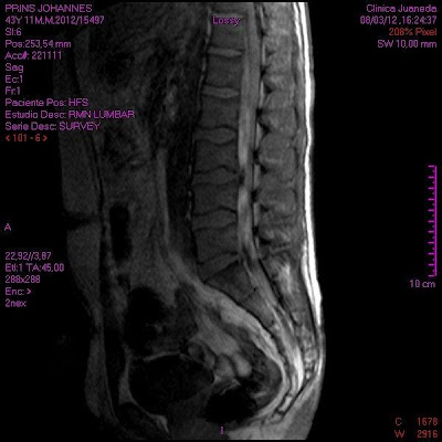 Prinsen en Prinsessen: Hernia en mijn MRI scan