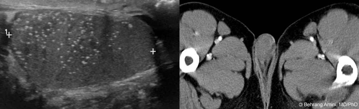 Roentgen Ray Reader Testicular Microlithiasis