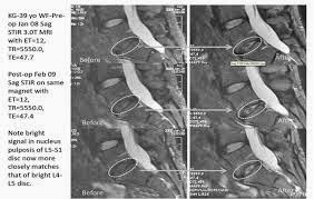 Medical Treatment Pictures-for Better Understanding: Discectomy Surgery ...
