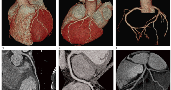 Pruebas Dx: ¿Qué es un TAC multicorte?