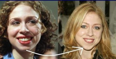 Chelsea Clinton Plastic Surgery Before and After Nose Job and Chin ...
