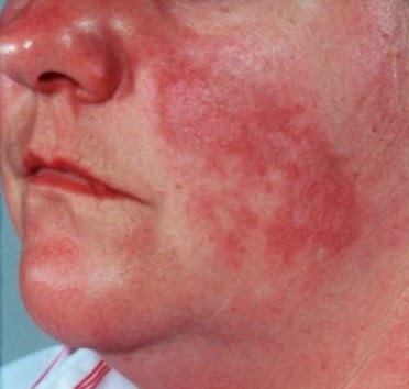 Scarlet Letters, dealing with vascular rosacea, face flushing, burning ...