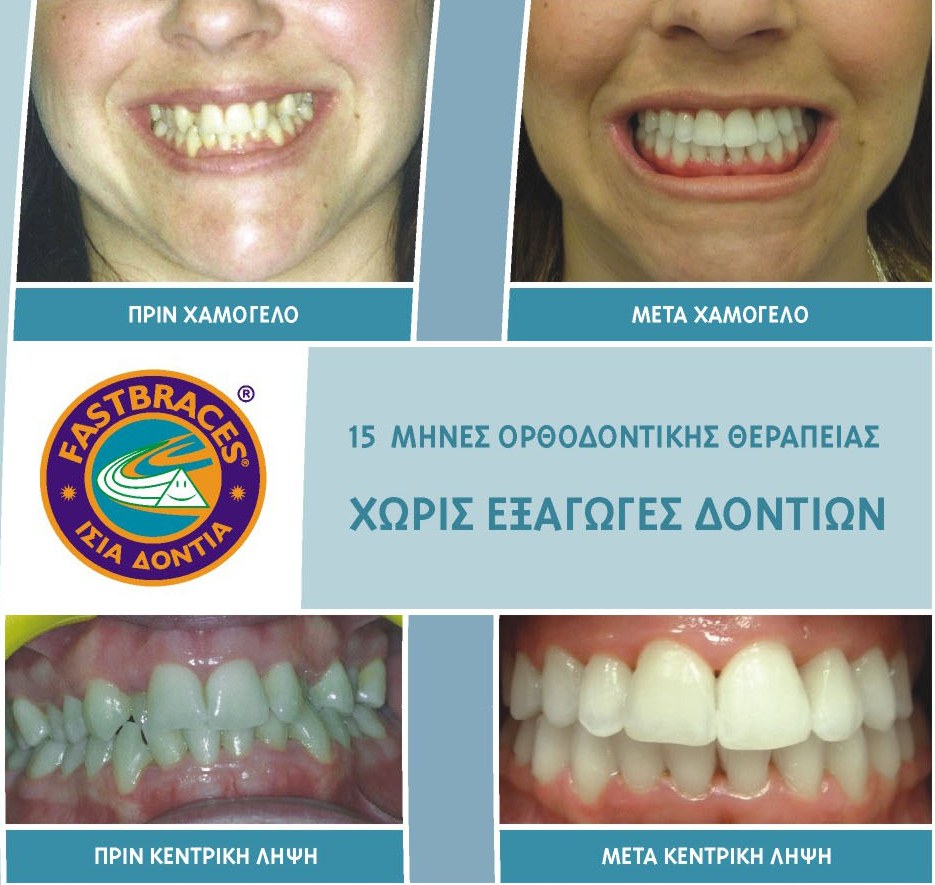 The Sekouratoi: ΟΡΘΟΔΟΝΤΙΚΗ (ΙΣΙΑ ΔΟΝΤΙΑ) ΣΕ ΛΙΓΟΤΕΡΟ ΧΡΟΝΟ ΚΑΙ ΧΩΡΙΣ ...