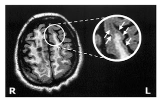 CADASILのガイドライン