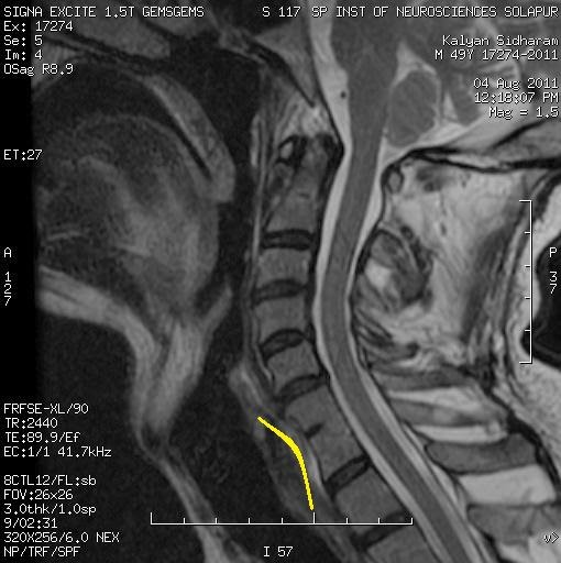 Neuroradiology Cases: 'Wasp waist' sign of Congenital fusion on MRI