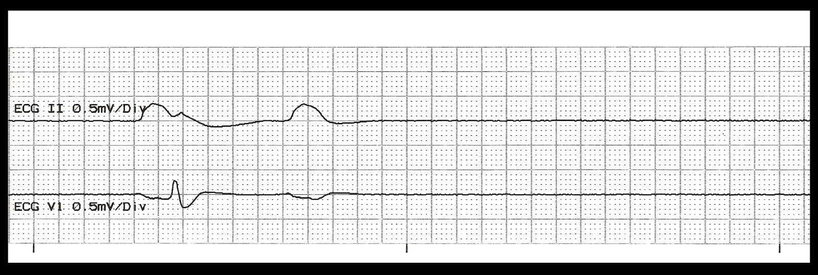 Float Nurse: ACLS review: asystole part 1